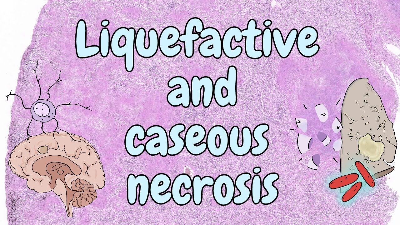 Liquefactive and caseous necrosis - general pathology