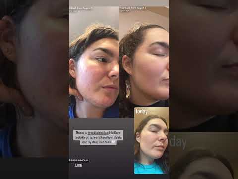 Healing Acne With Medical Medium