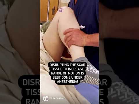 MUA after Knee Replacement. Breaking scar tissue loose is a happier experience under anesthesia!