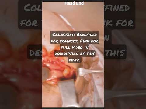 Colostomy: Permanent End Colostomy After APR: Stoma Series Video - 3. #shortsfeed