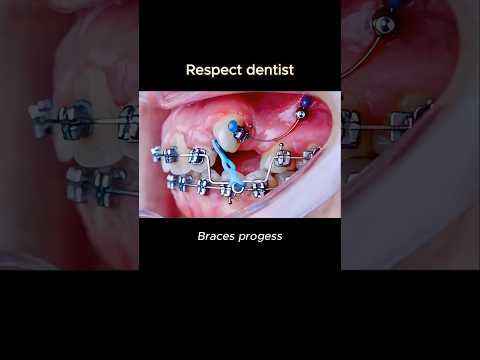 Braces as magic. Respect the dentist #braces #dentist #orthodontist