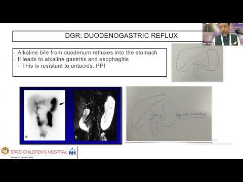 Why roux en y Hepaticojejunostomy is better than hepaticodudenostomy, Dr Rasik Shah