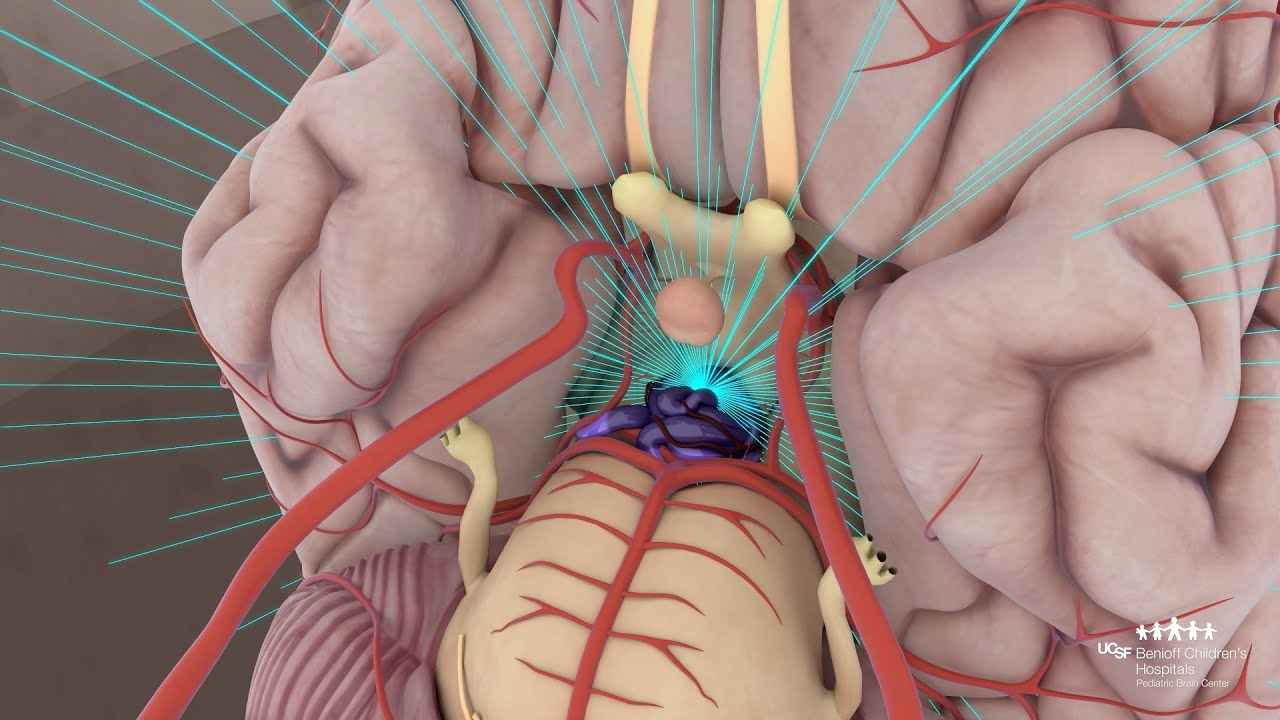 Pediatric Arteriovenous Malformations (AVMs) Treatment Options | UCSF Pediatric Brain Center
