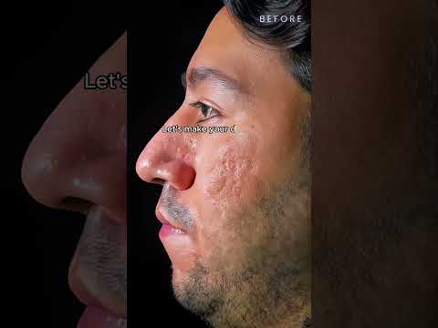 SUBCISION FOR SEVERE ACNE SCARS ⤵️