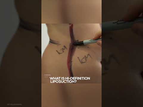 What is Hi-Definition Lipo? #bbl #bbljourney #fypシ #plasticsurgeon #kimkardashian #trending #lipo360