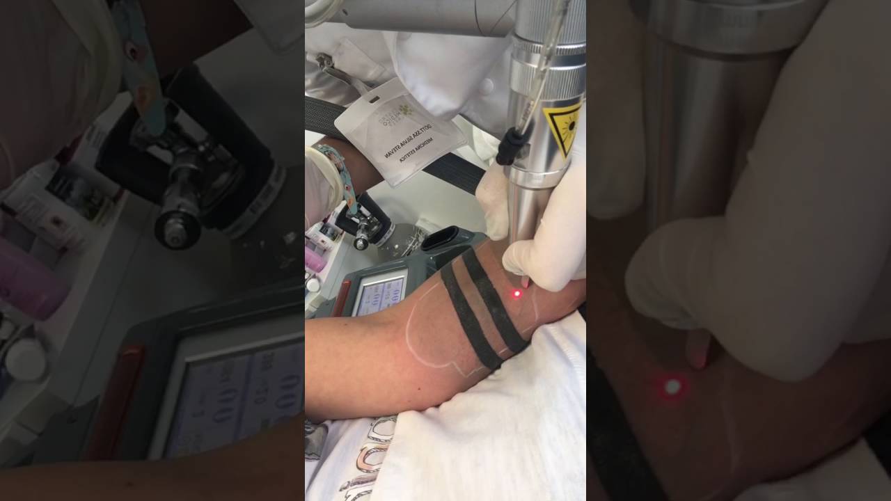 Rimozione inchiostro migrato dal tatuaggio