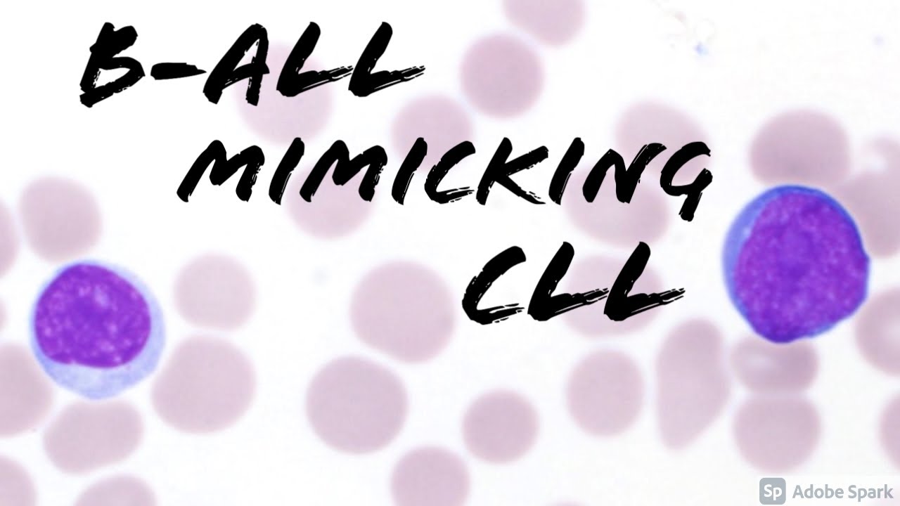 B-ALL (B-Lymphoblastic Leukemia/Lymphoma) w/ Smudge Cells Mimicking CLL Chronic Lymphocytic Leukemia