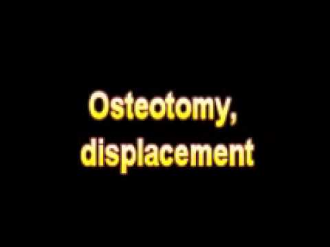 What Is The Definition Of Osteotomy, displacement
