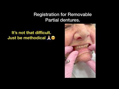 Registration sequence for a removable partial denture