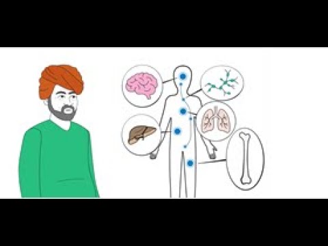 Cancer Basics – What is metastatic cancer?