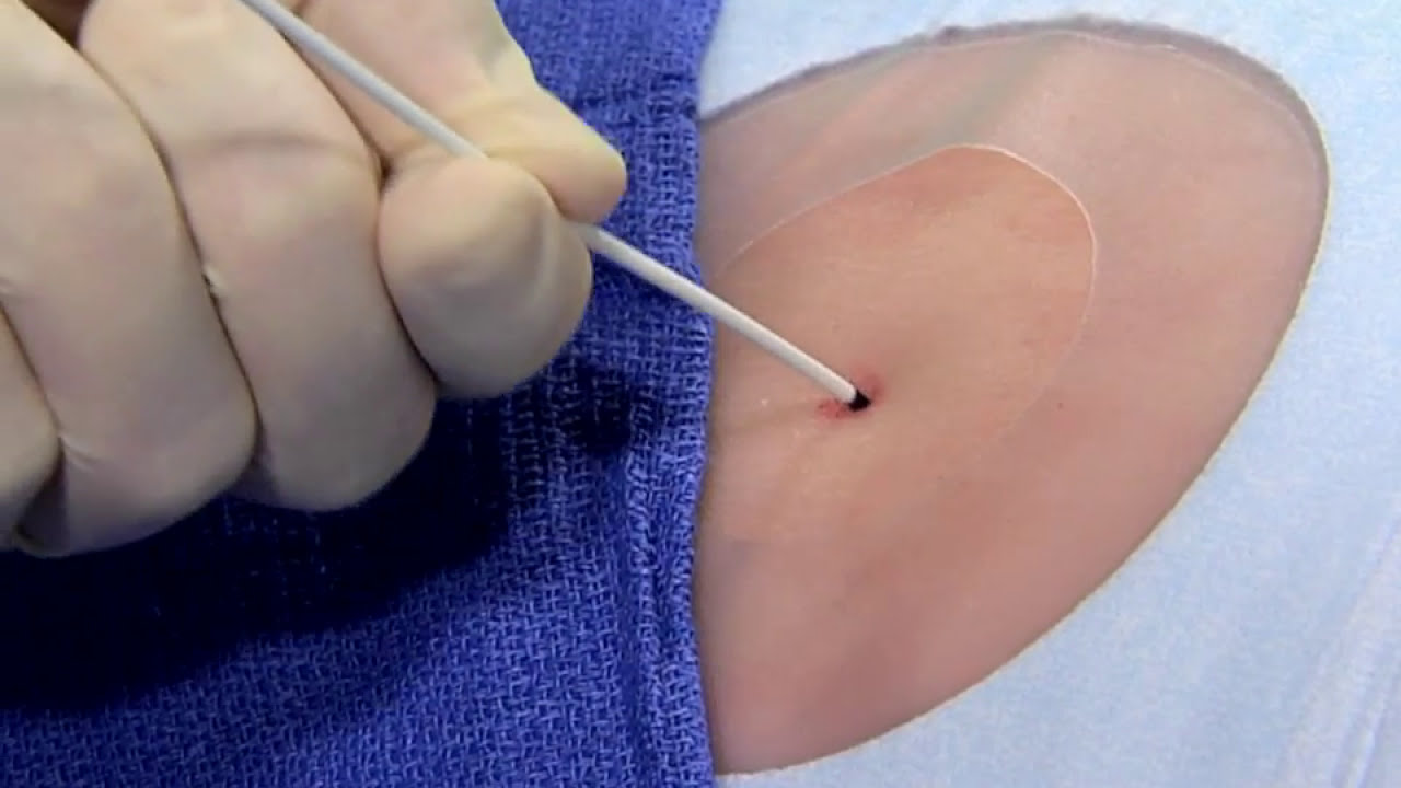 MAK-NV™ Introducer System