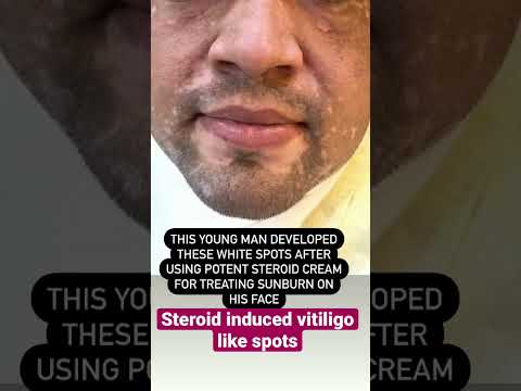 Steroid induced vitiligo like white spots | Dr Ashima Goel |Dermatologist|vitiligo treatment #shorts