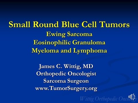 Ewing Sarcoma Oncology Medbullets Step 23