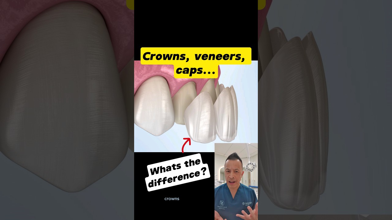 Crowns, Veneers, or Caps? What's the Difference? #dentallan #dentist #shorts