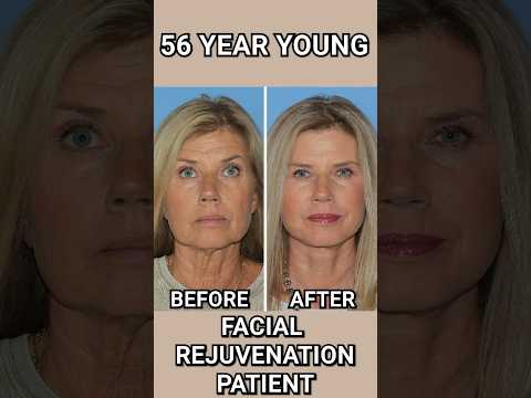 SUBTLE yet SIGNIFICANT Mini Facelift Transformation #antiaging #facelift #goviral