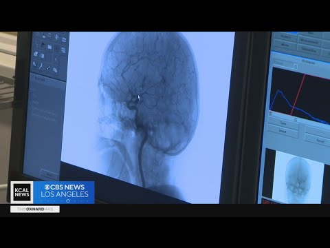 Man recovers from extremely rare brain operation at St. Mary's Medical Center in Long Beach