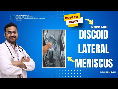 Discoid Lateral Meniscus..How To Read Knee MRI ?Dr Sai Chandra..Knee N Shoulder Surgeon in Hyderabad