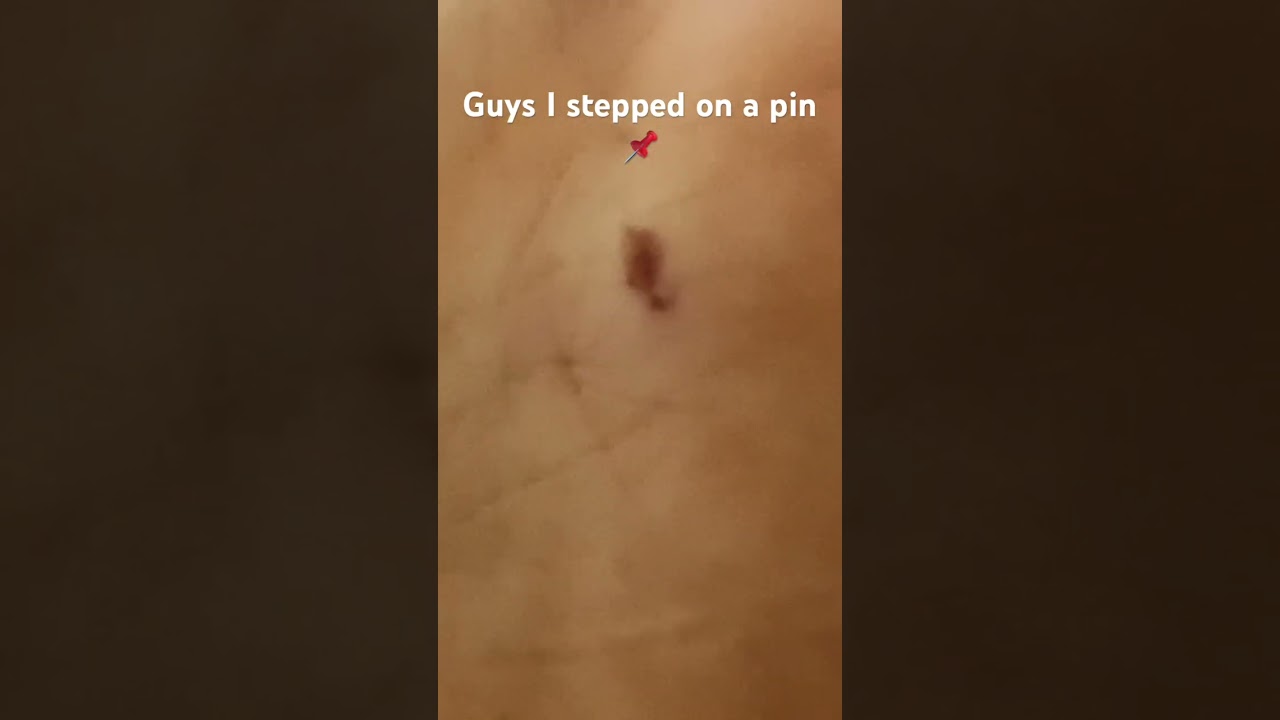 I stepped on a pin and it went super deep on my feet #shorts #pin #june2025 #june16