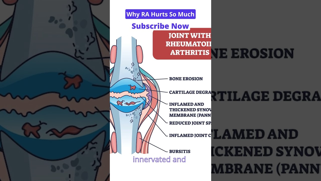 Why Rheumatoid Arthritis Hurts So Much