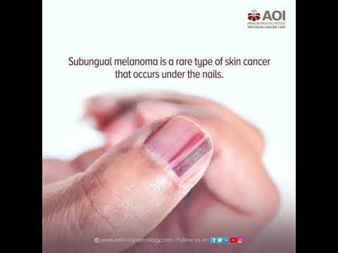 "Skin Cancer Awareness: Recognizing Signs of Discoloration and Nail Texture Changes"