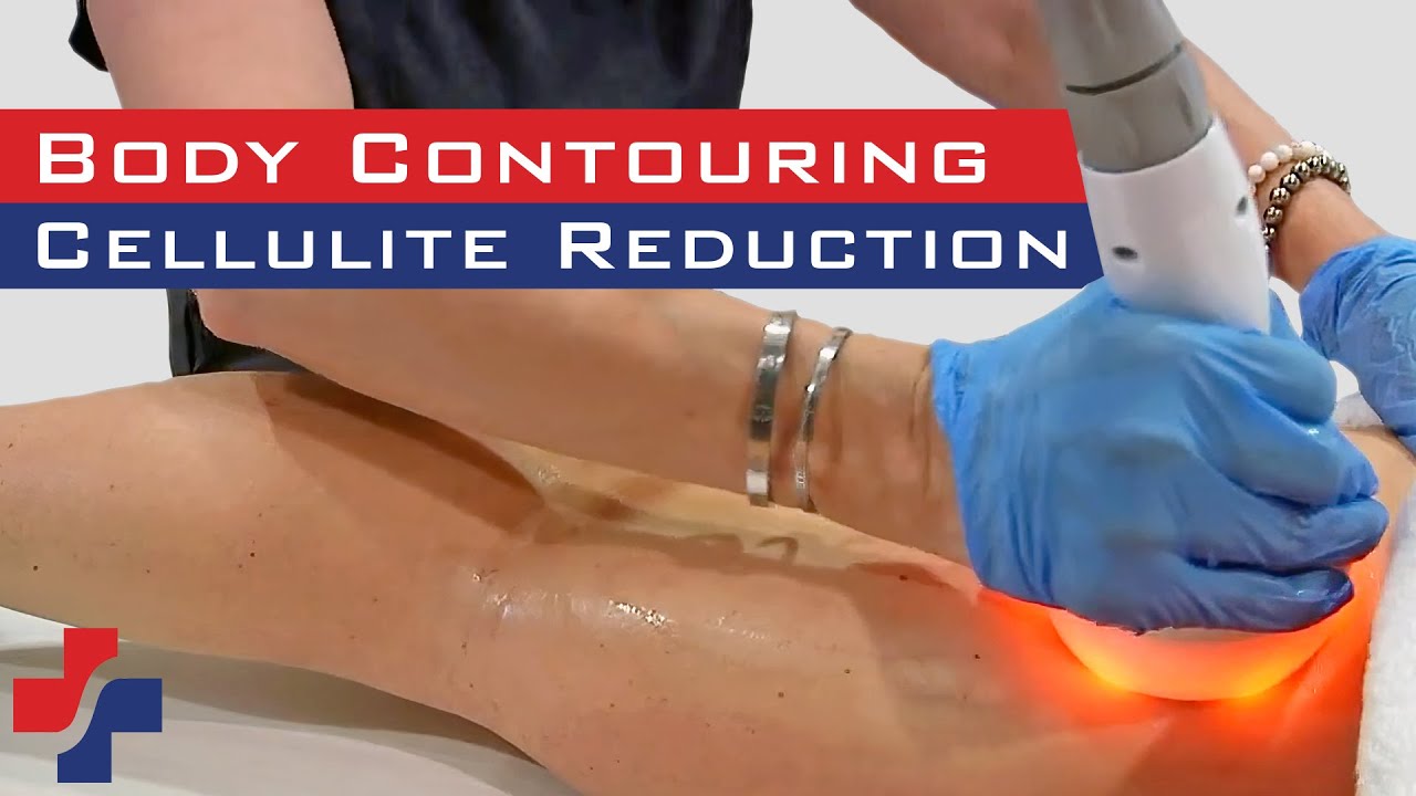 Body Contouring and Cellulite Reduction with the Most Popular Radio-Frequency Device