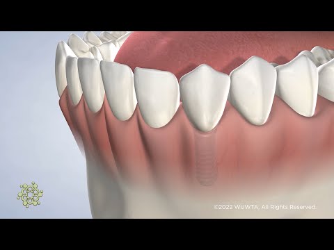 Dental Implants with Dr. Rehrer at Beacon Oral & Maxillofacial Surgeons