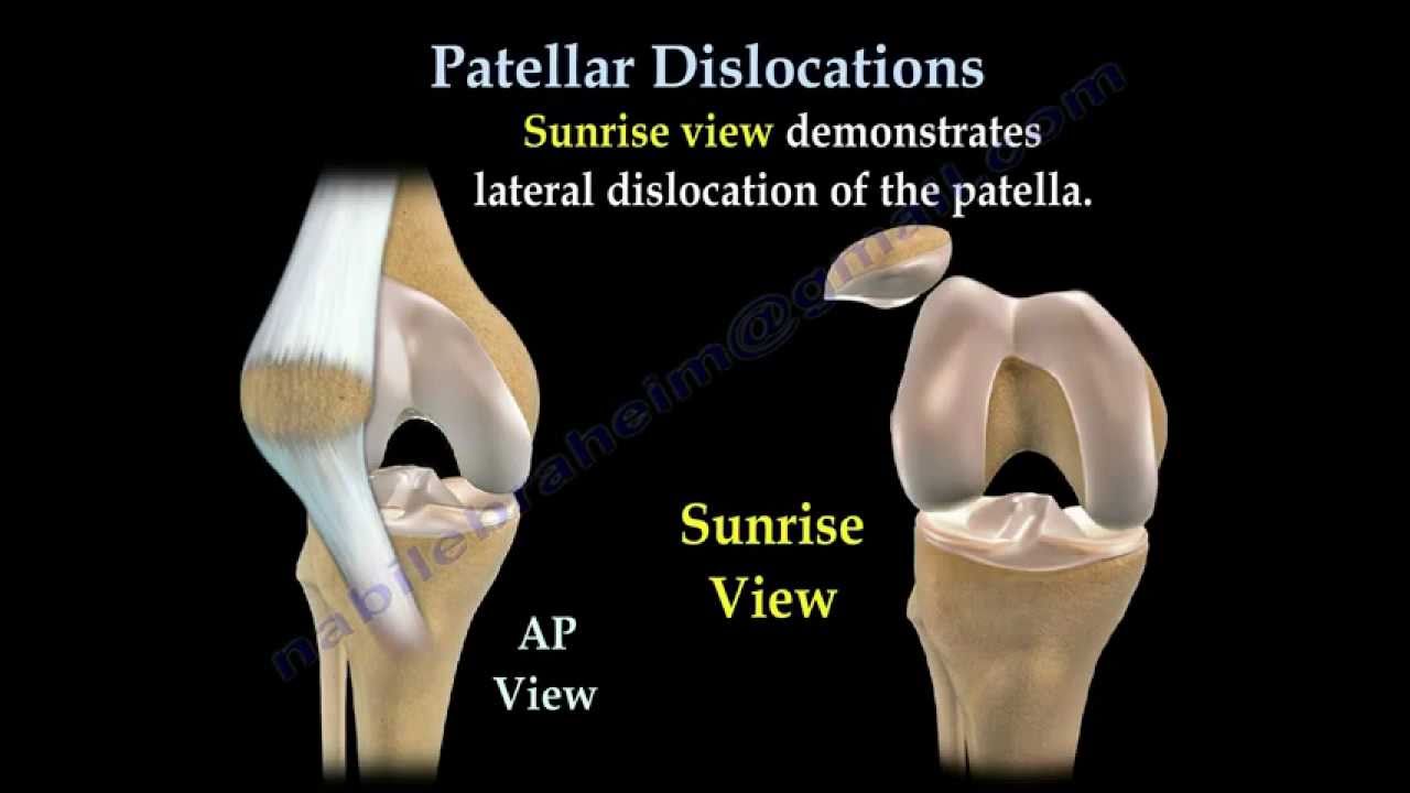 Patellar Dislocations - Everything You Need To Know - Dr. Nabil Ebraheim