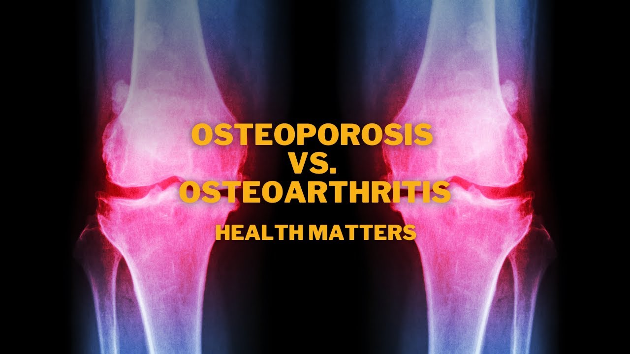 Your Bone Structure Explained: What Is Osteoarthritis, Osteoporosis And The Difference Between Them!