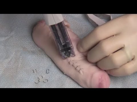 Skin Staplers - Disposable Skin Stapler Latest Price, Manufacturers ...