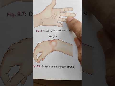 Dupuytren's Contracture and ganglion meaning explanation