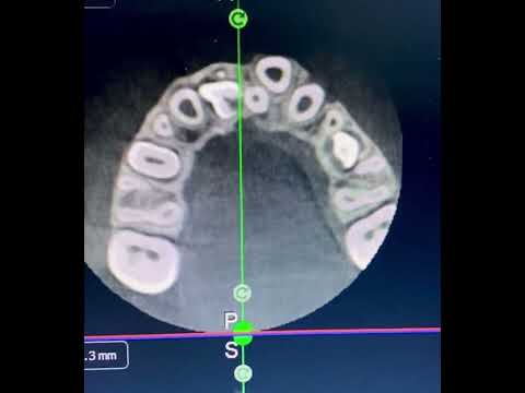 Maxillary supernumerary teeth, CBCT coronal section