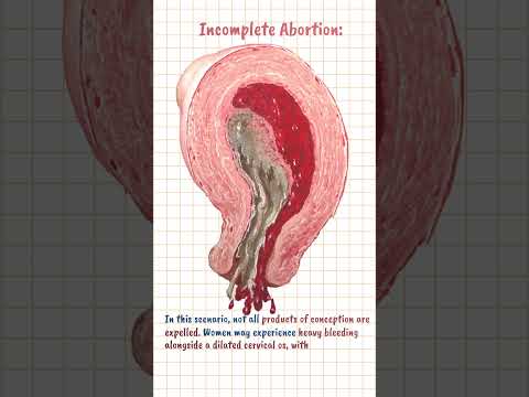 Understanding Incomplete Abortion And Vaginal Bleeding In Early Pregnancy