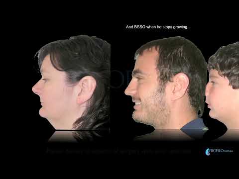 Overbite Side Profile - How To Discuss