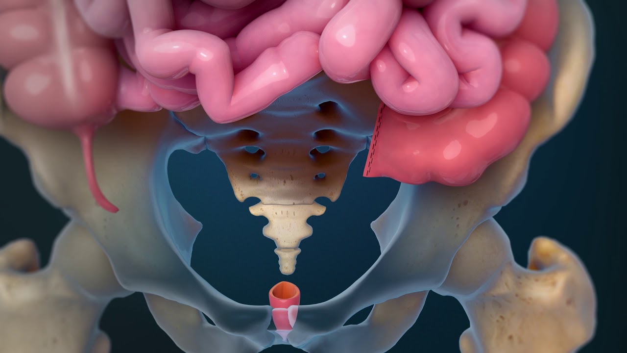 Learn about Rectum Removal