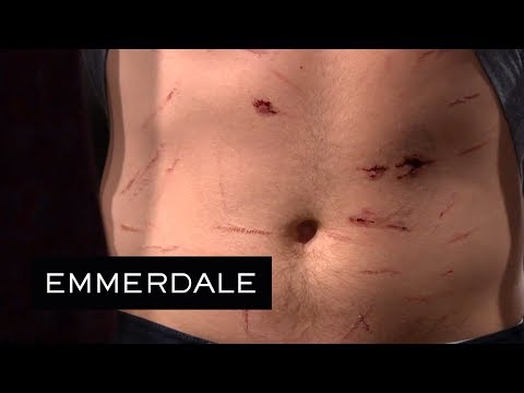 Emmerdale - Aaron's Bloodstained Stomach Is Revealed
