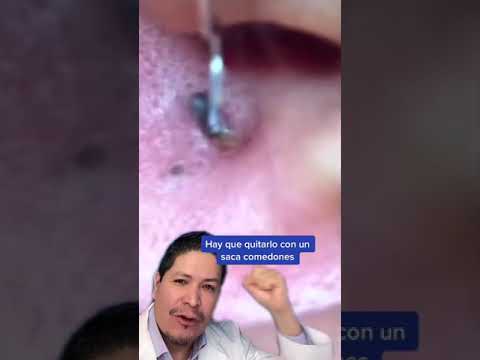 PUNTO NEGRO GIGANTE EN OREJA #shorts