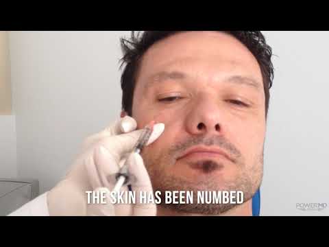 Men's Under Eye Filler