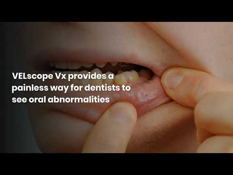 VELscope Vx provides a painless way for dentists to see oral abnormalities