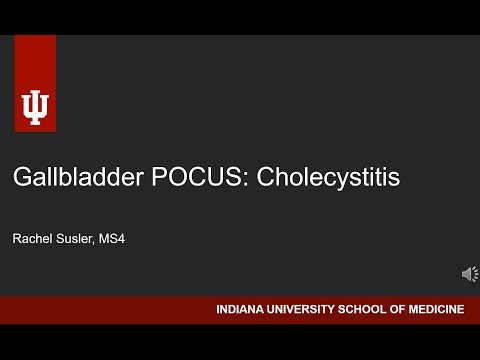 POCUS Gallbladder Cholecystitis video