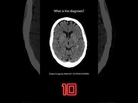 Brain CT Question 31