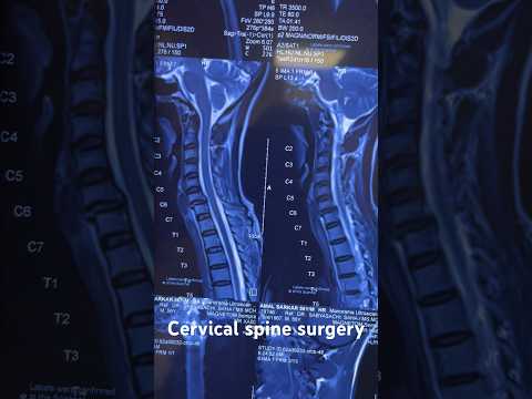 Cervical spine surgery #neurosurgery #doctor #neetmotivation