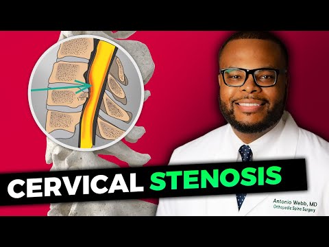 What is Cervical Stenosis? | Antonio Webb, M.D.