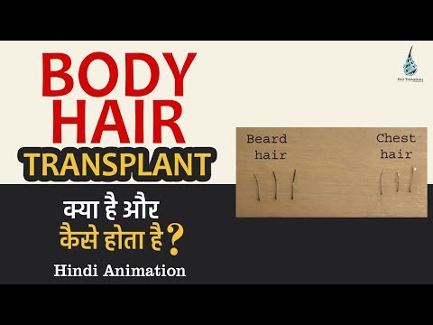 BODY HAIR TRANSPLANT – HOW IT IS DONE ? | BODY HAIR TRANSPLANT SUCCESS RATE | Dr. ASHOK SINHA