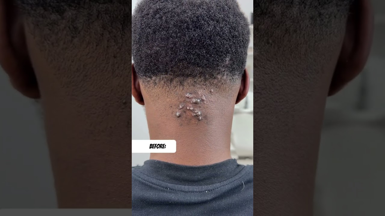 Say goodbye to folliculitis, scalp ringworm, and seborrheic dermatitis with Amanda Shampoo!