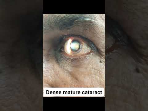 Dense mature cataract#ophthalmology #ophthalmologist #optometry #eyedoctor #vision #eyehealth