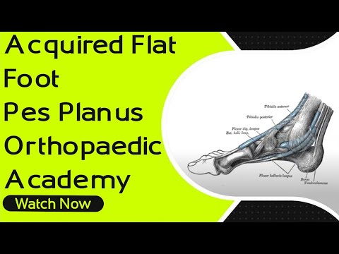 Acquired Flat Foot | Pes Planus. Orthopaedic Academy
