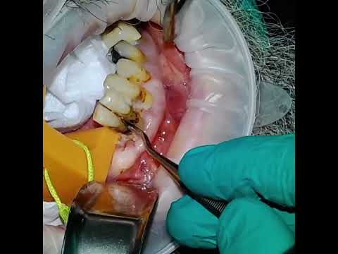 Simple Extractions due to severe periodontal disease