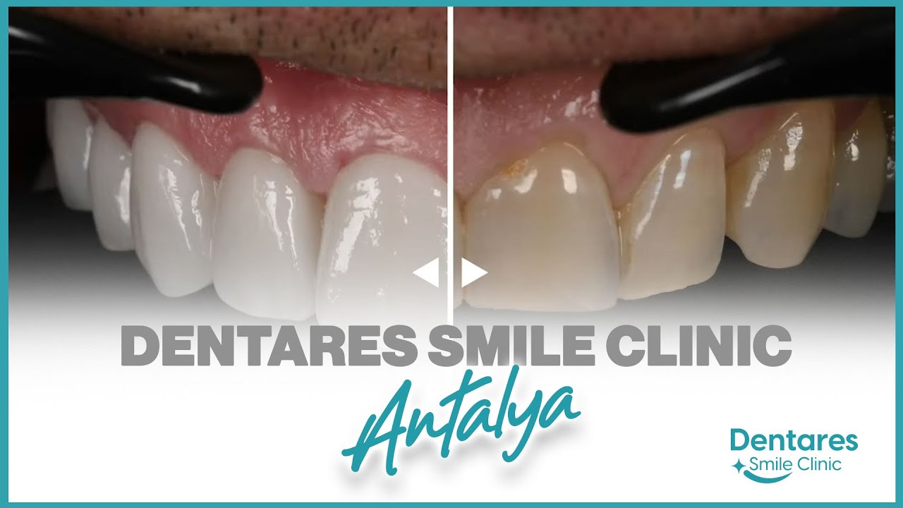 How to Get Your Teeth Done in Turkey – Dentares Smile Clinic