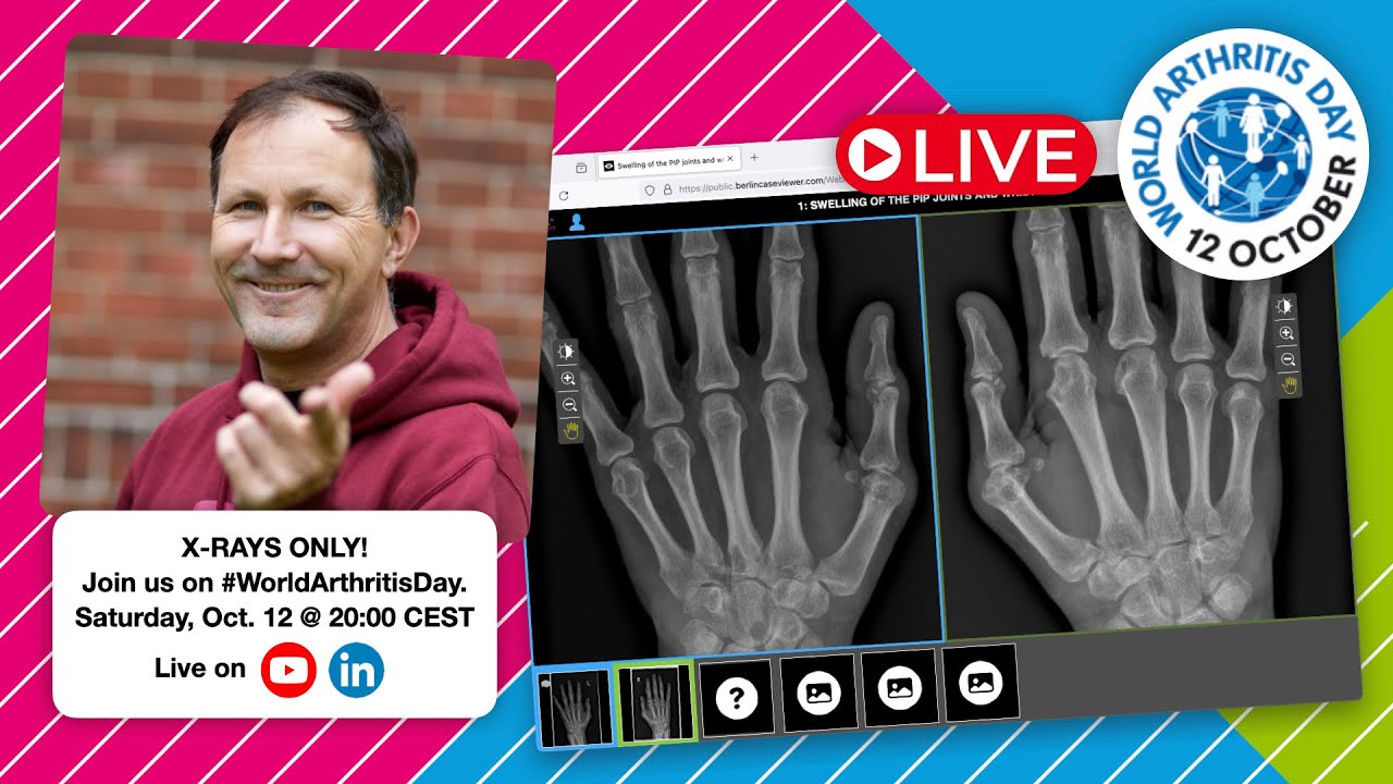 X-RAYS ONLY // World Arthritis Day 2024 Special