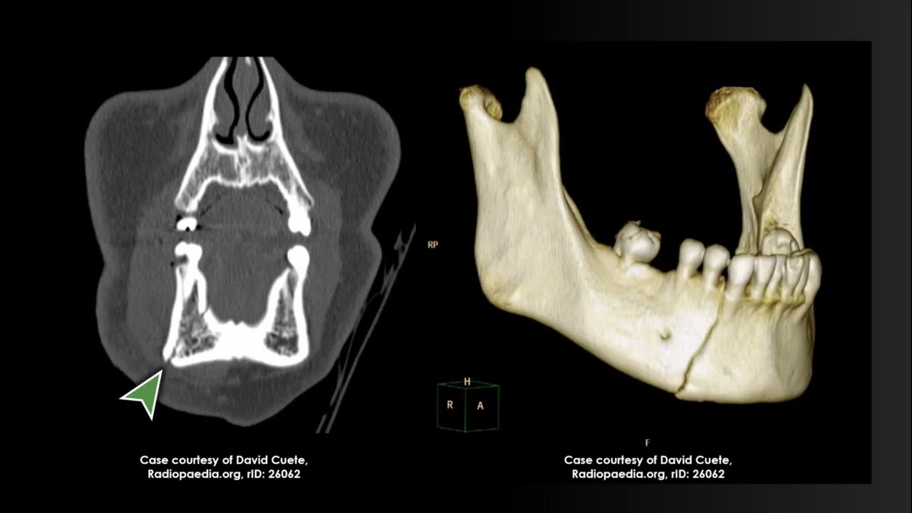 Recognizing Facial Fractures on CT Scans